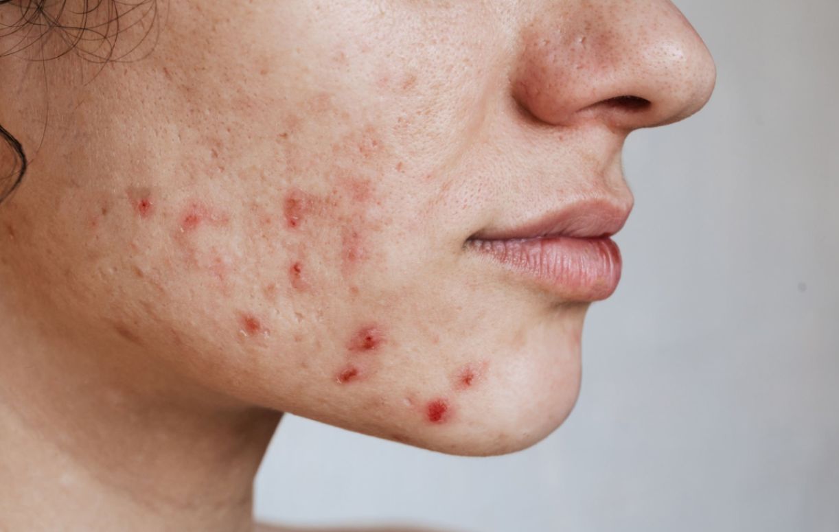 Acne & PCOS Acne – Skin – RPMDerma