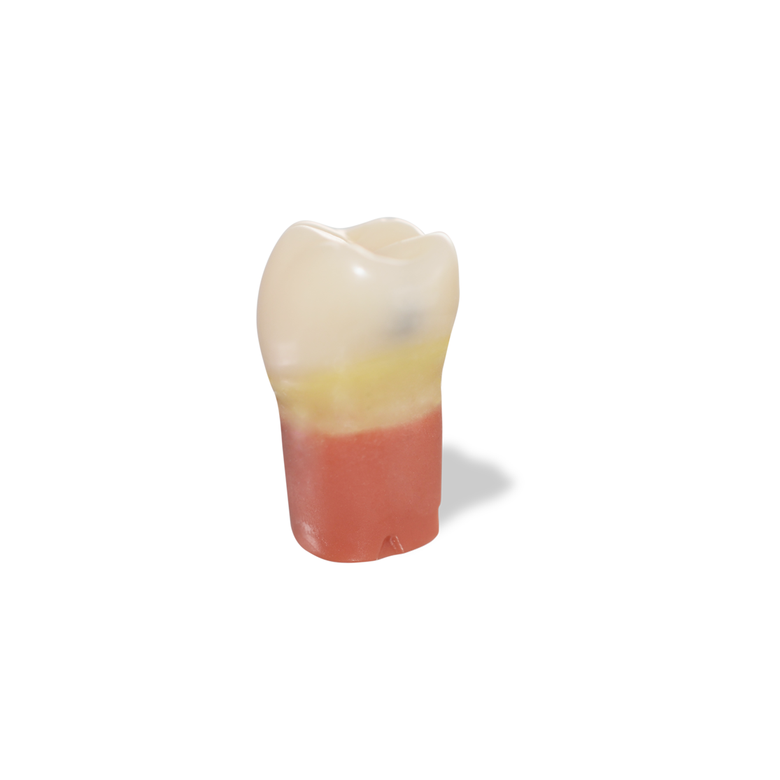 Acadental - RTX Caries Teeth Mesial #30