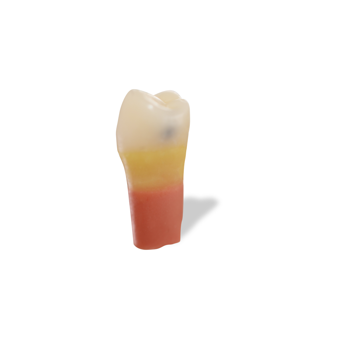 Acadental - RTX Caries Teeth Distal #20