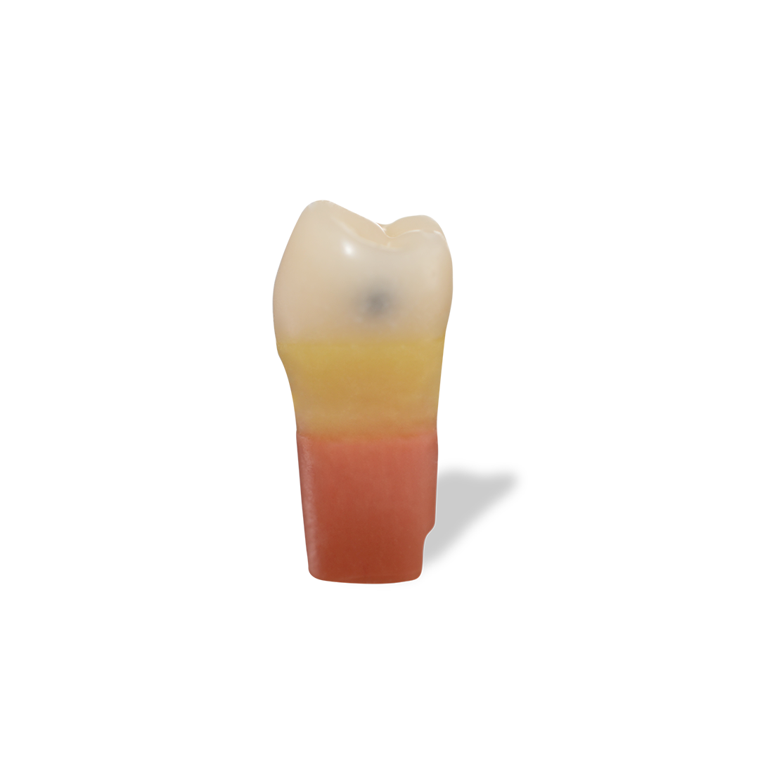 Acadental - RTX Caries Teeth Distal #20