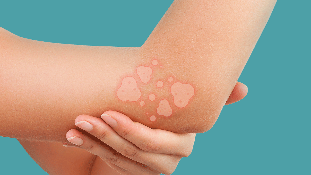 External skin creams/ointments/solutions