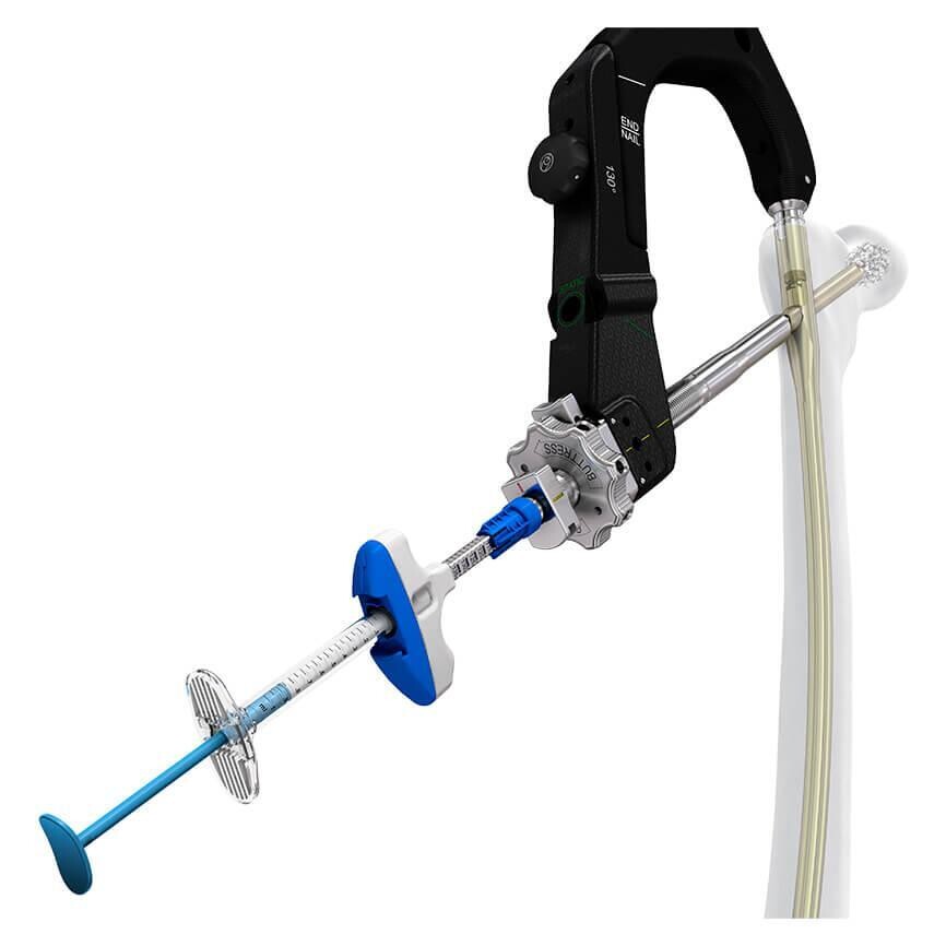 TFNA TRAUMACEM™ V+ Augmentation System