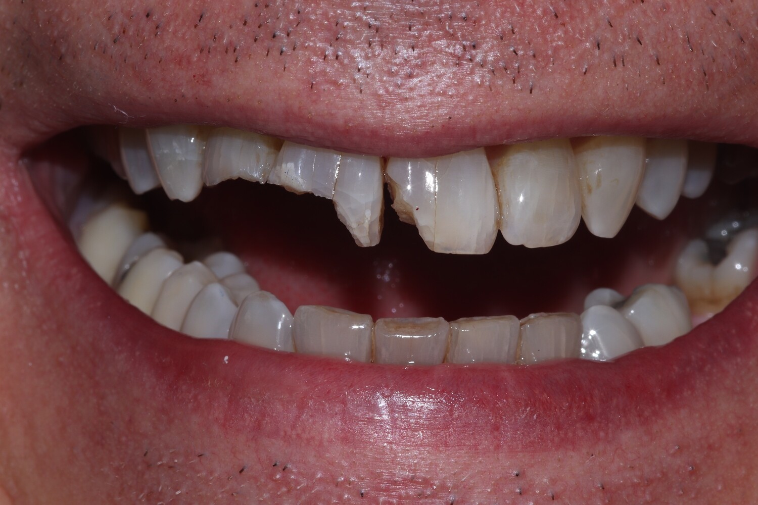 Injection Moulding and the Bioclear Technique for Composites Hands-On ...