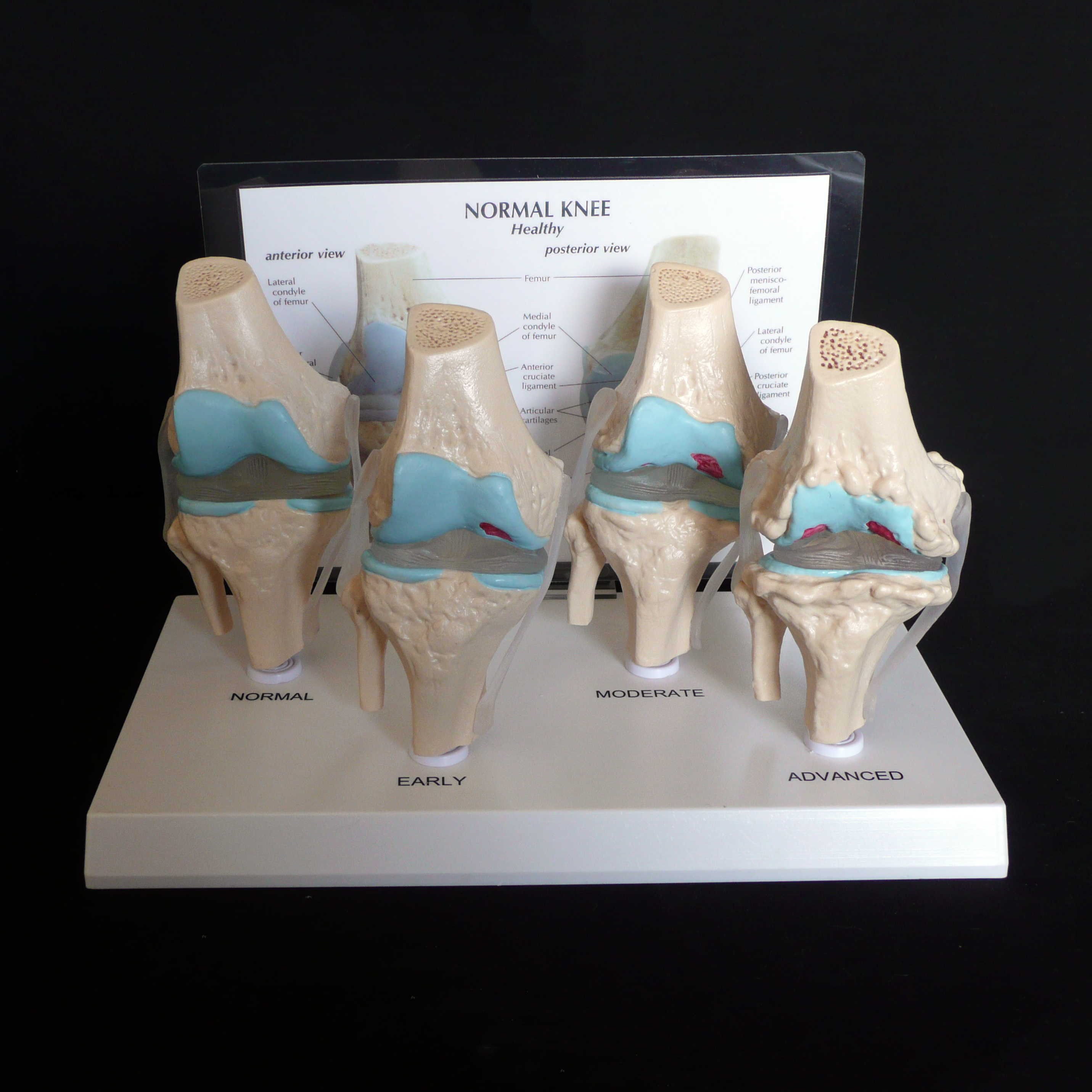 Anatomical Human Degenerative Knee Joint Disease Model | Joints – Store ...