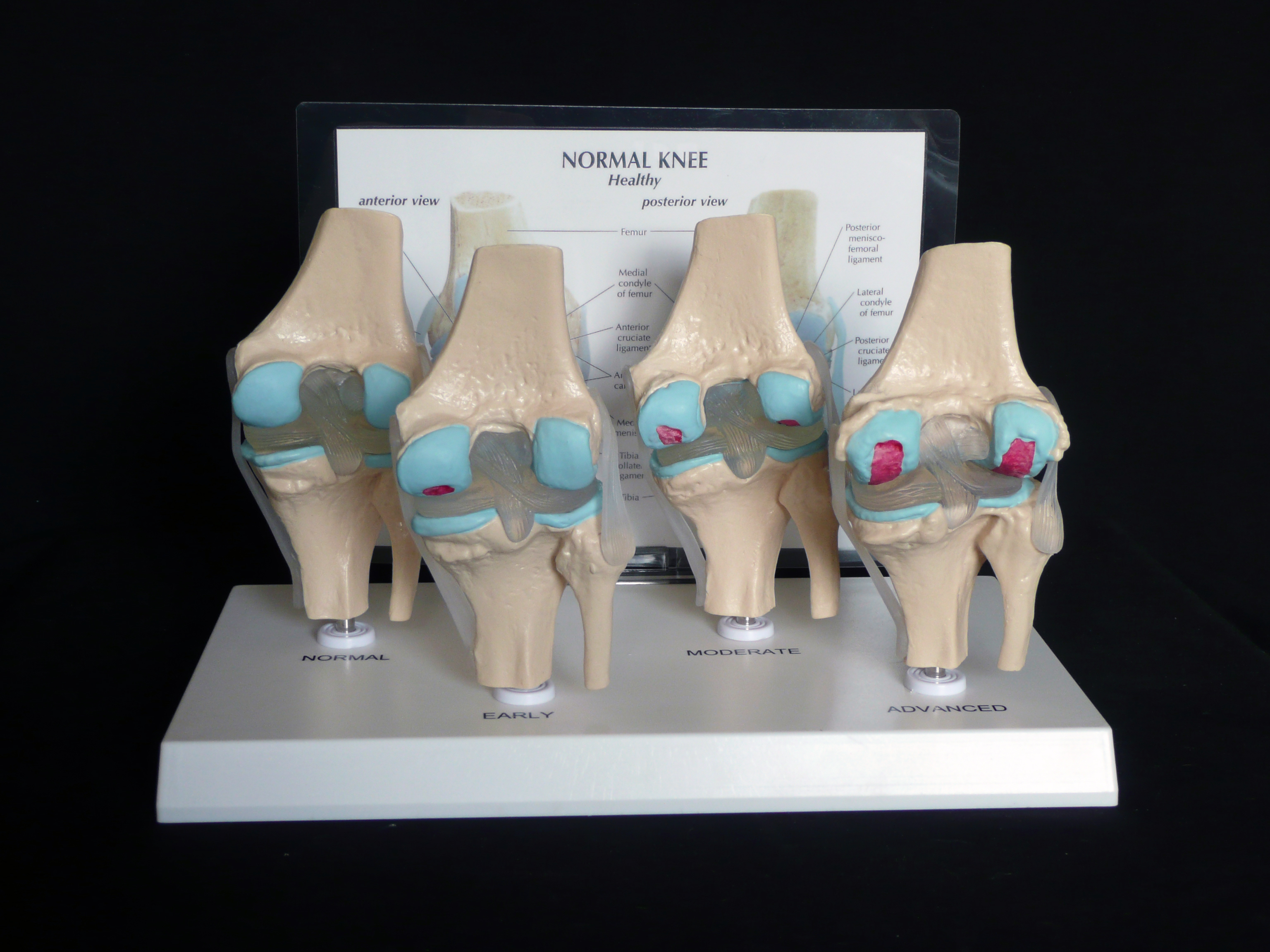 Anatomical Human Degenerative Knee Joint Disease Model | Joints – Store ...
