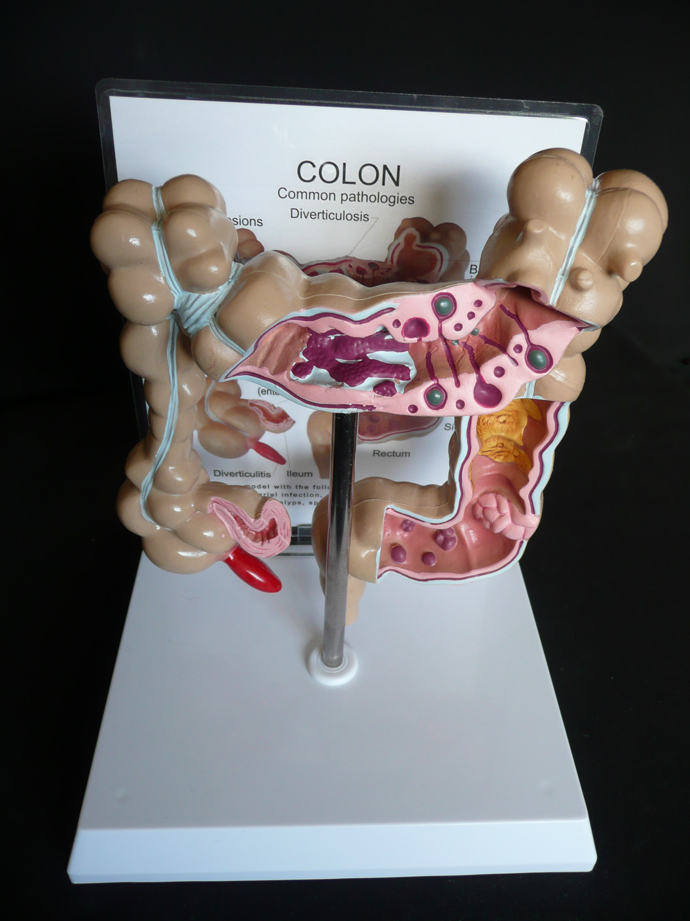 Anatomical Human Colon Pathological Diseases Model | Organs – Store ...