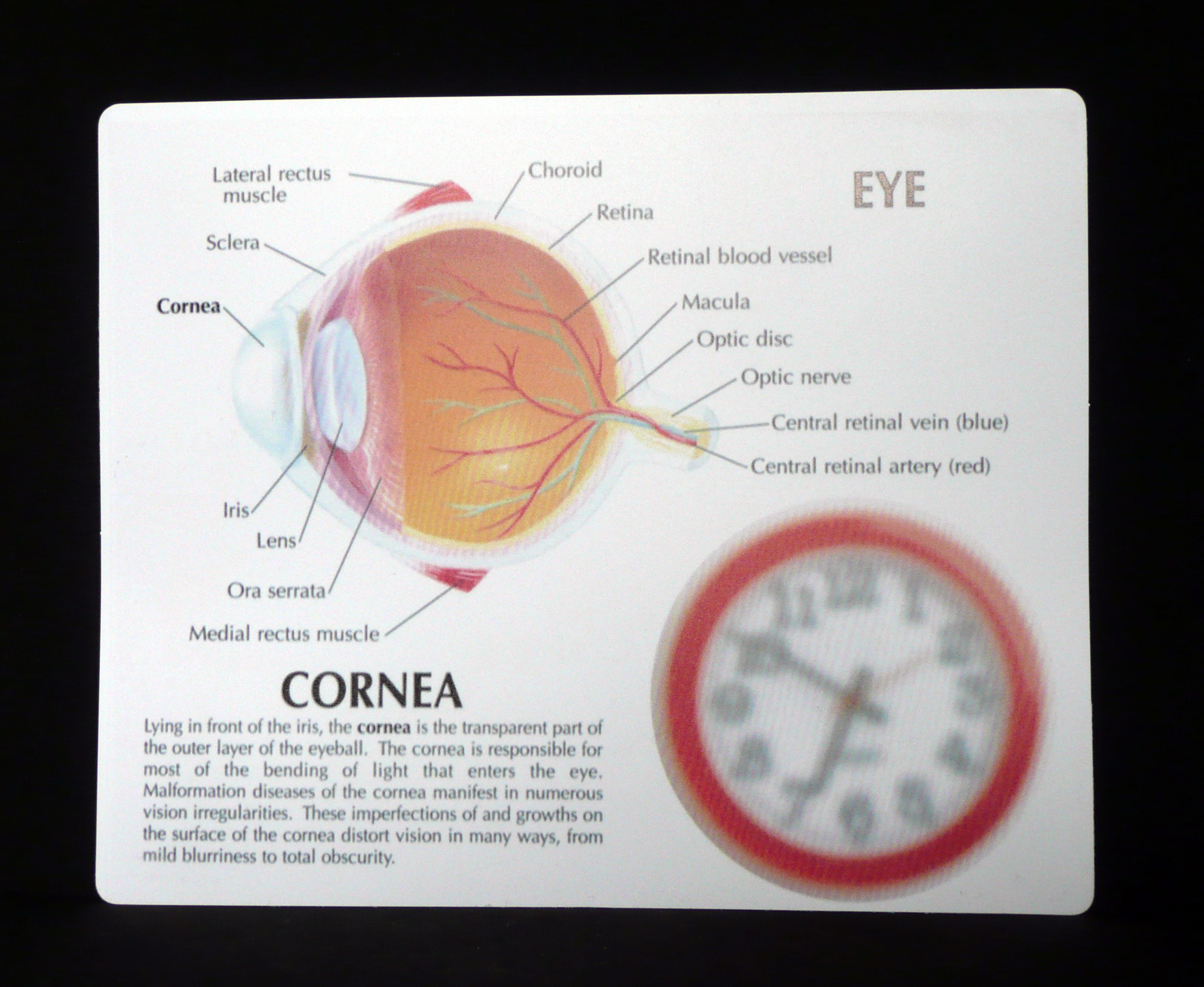 Anatomical Human Cornea Disease Eye Model | Eye Models – Products ...