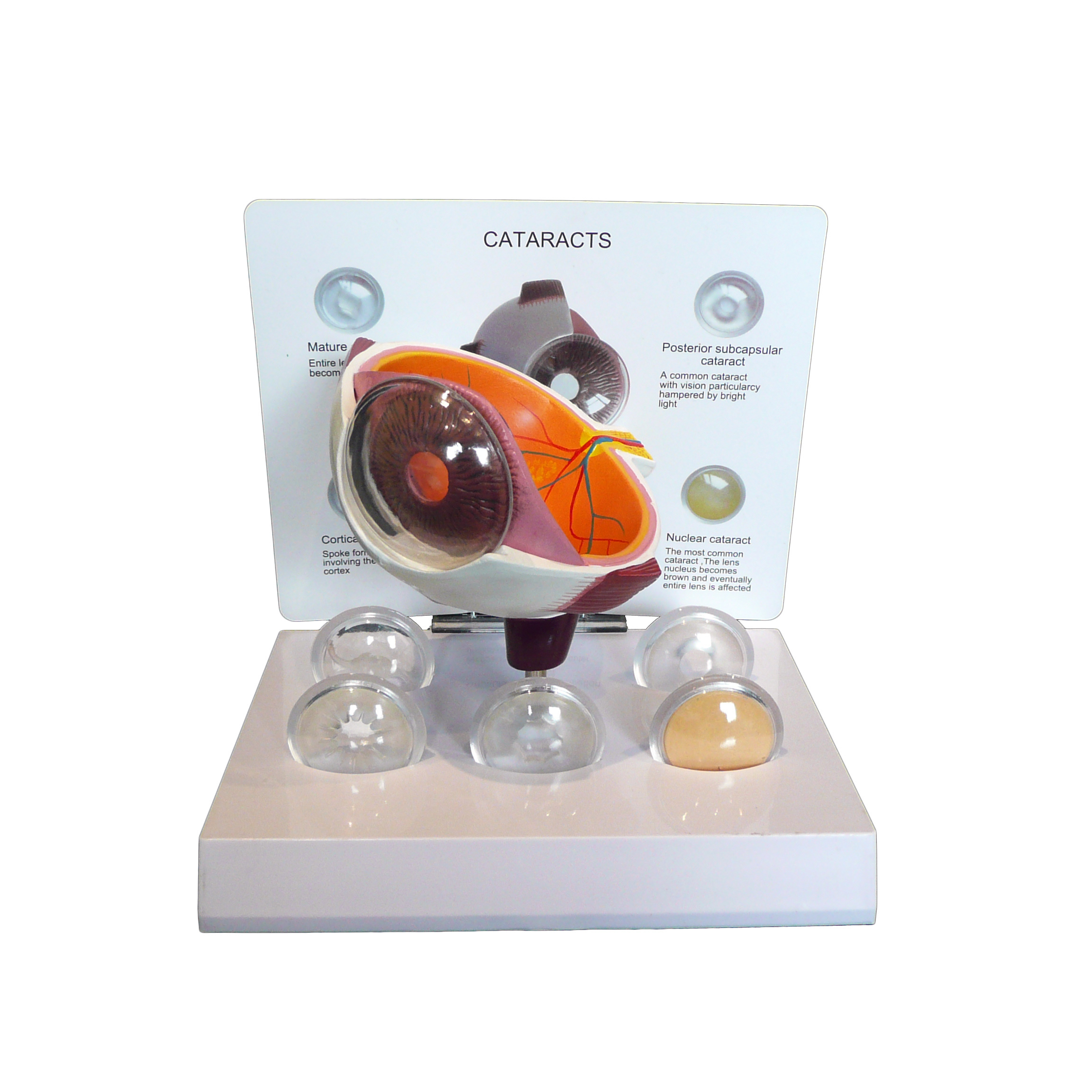 Anatomical Human Cataract Eye Model | Eye Models – Store – Medical Models