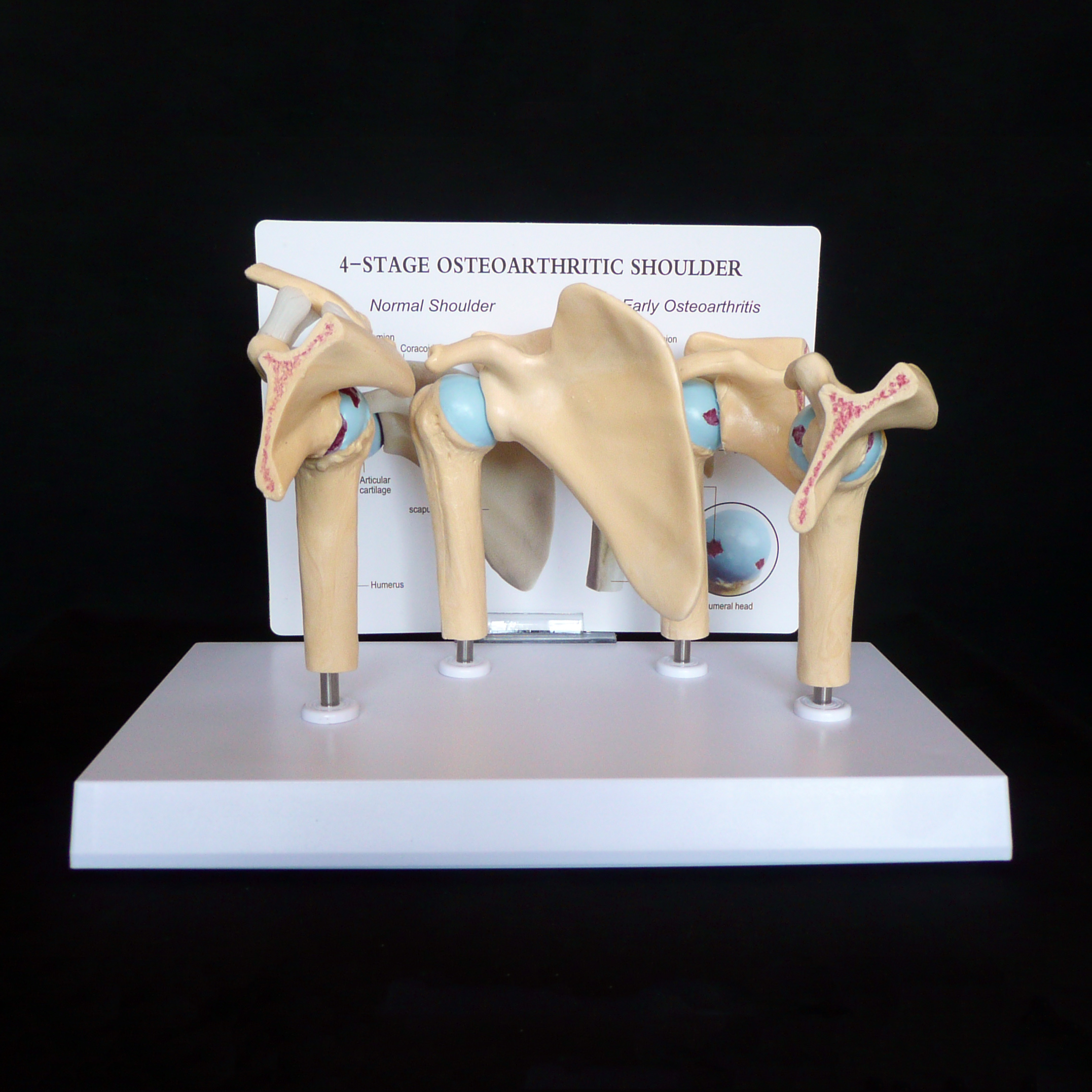Anatomical Human Shoulder 4-Stage Osteoarthritic Glenohumeral Joint ...