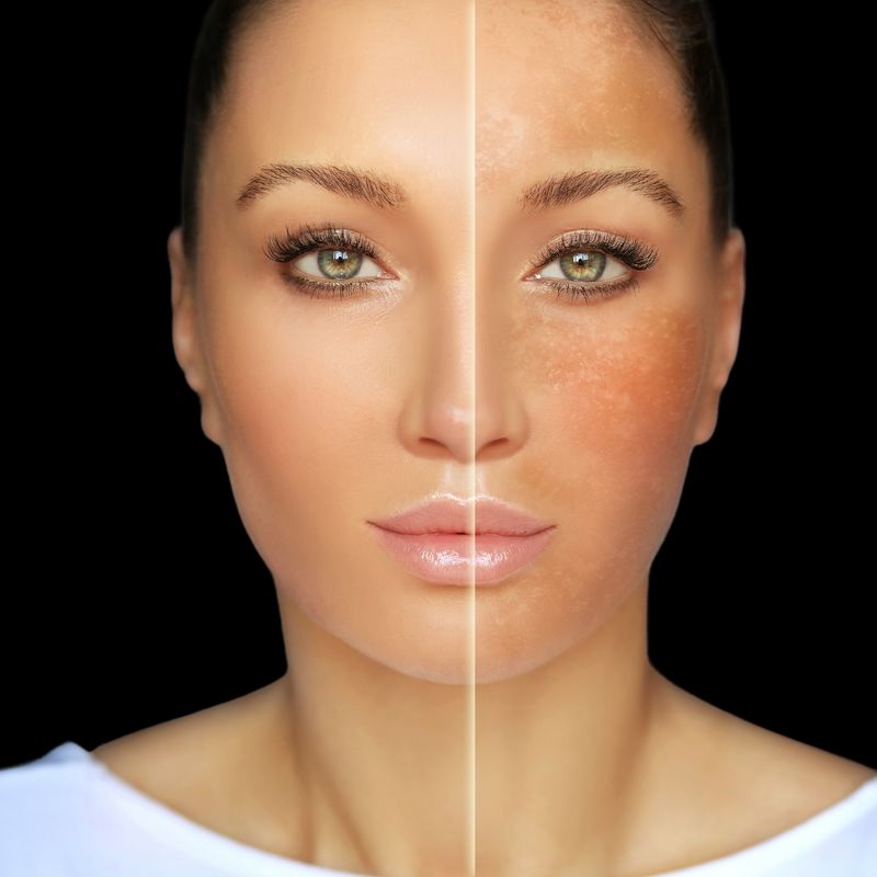 Hyperpigmentation