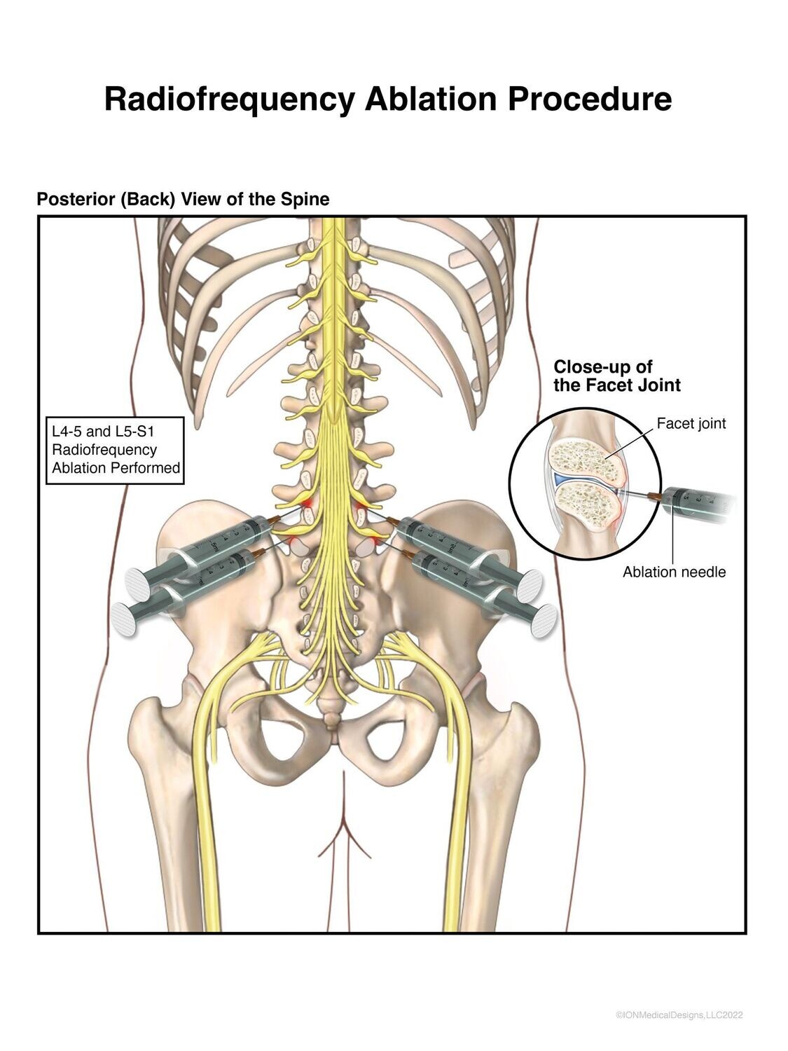 Radiofrequency Ablation Procedure