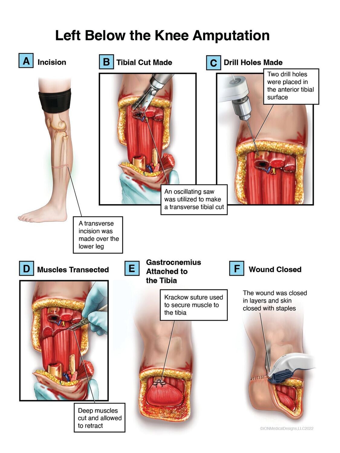 Left Below the Knee Amputation