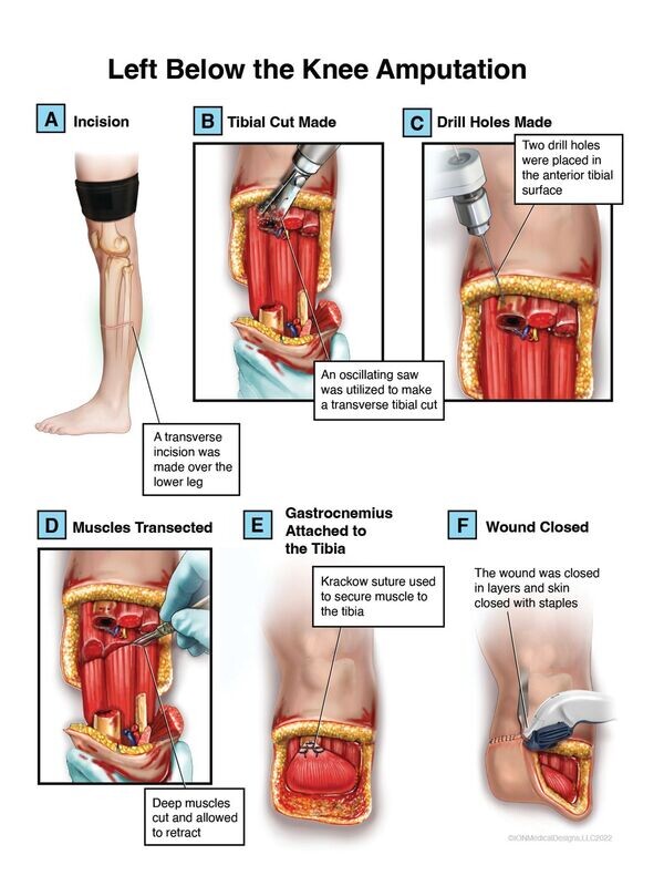 Left Below the Knee Amputation