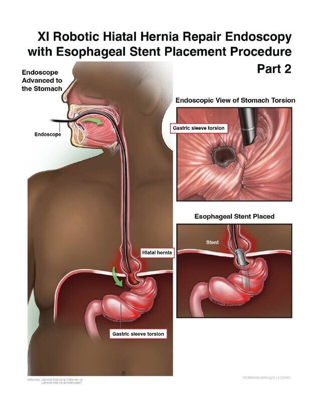 Xi Robotic Hiatal Hernia Repair Endoscopy With Esophageal Stent 8827